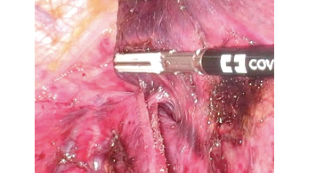 Outflow Control of the Right Hepatic Vein During Laparoscopic Right ...